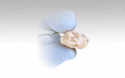 CartiMax® - Viable Cartilage Allograft